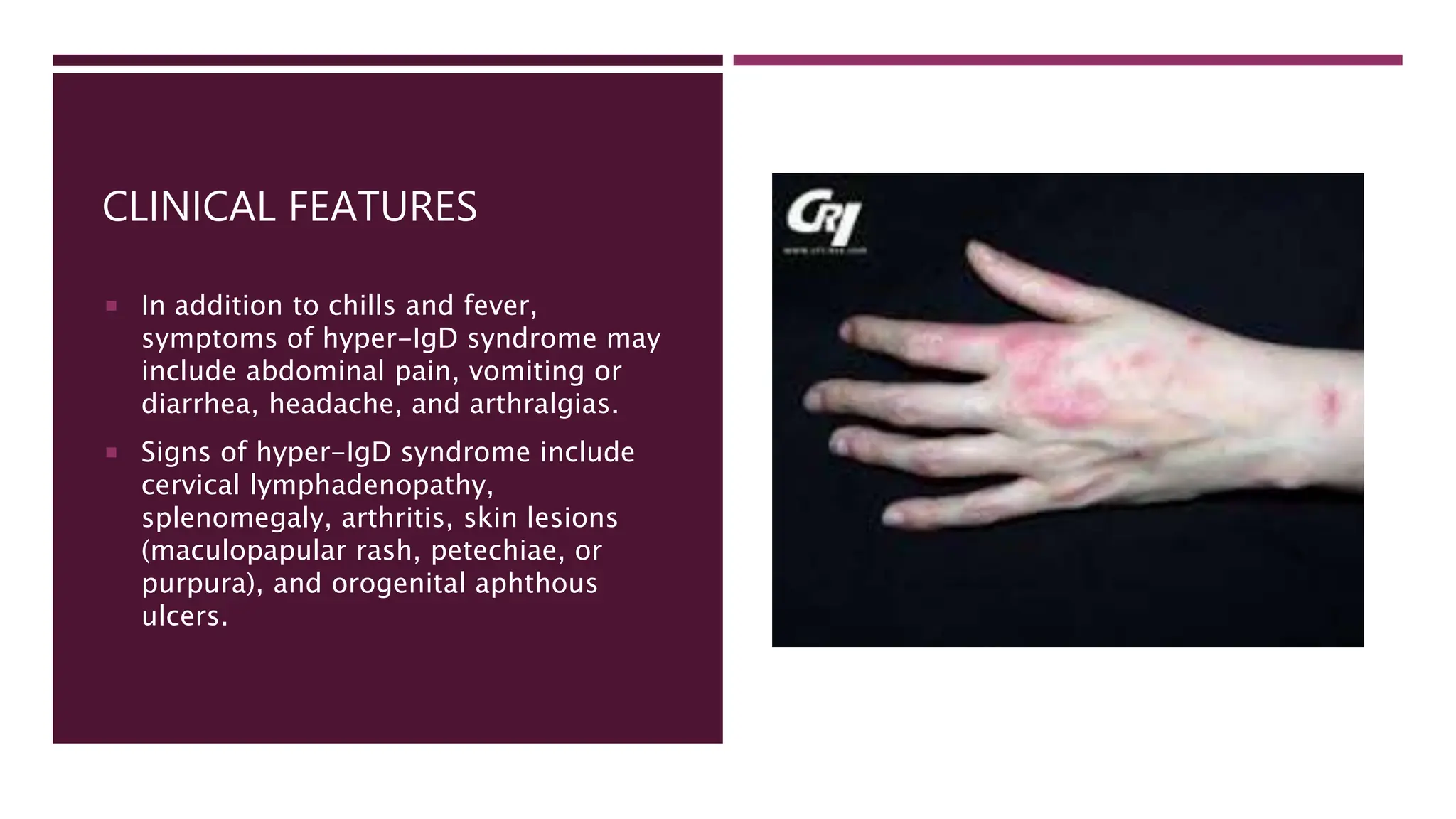 Periodic Fever syndromes- group of rare conditions that cause children ...