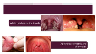 Periodic Fever syndromes- group of rare conditions that cause children ...