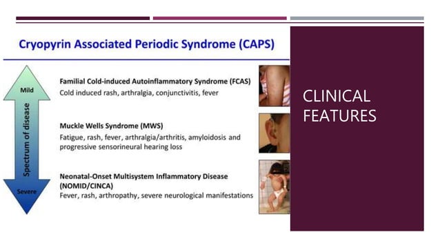 Periodic Fever syndromes- group of rare conditions that cause children ...