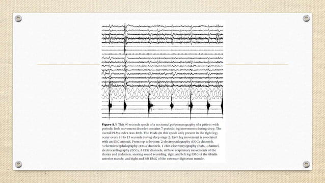 Periodic Limb Movement Disorder | PPTX | Sleep Disorders | Diseases and ...