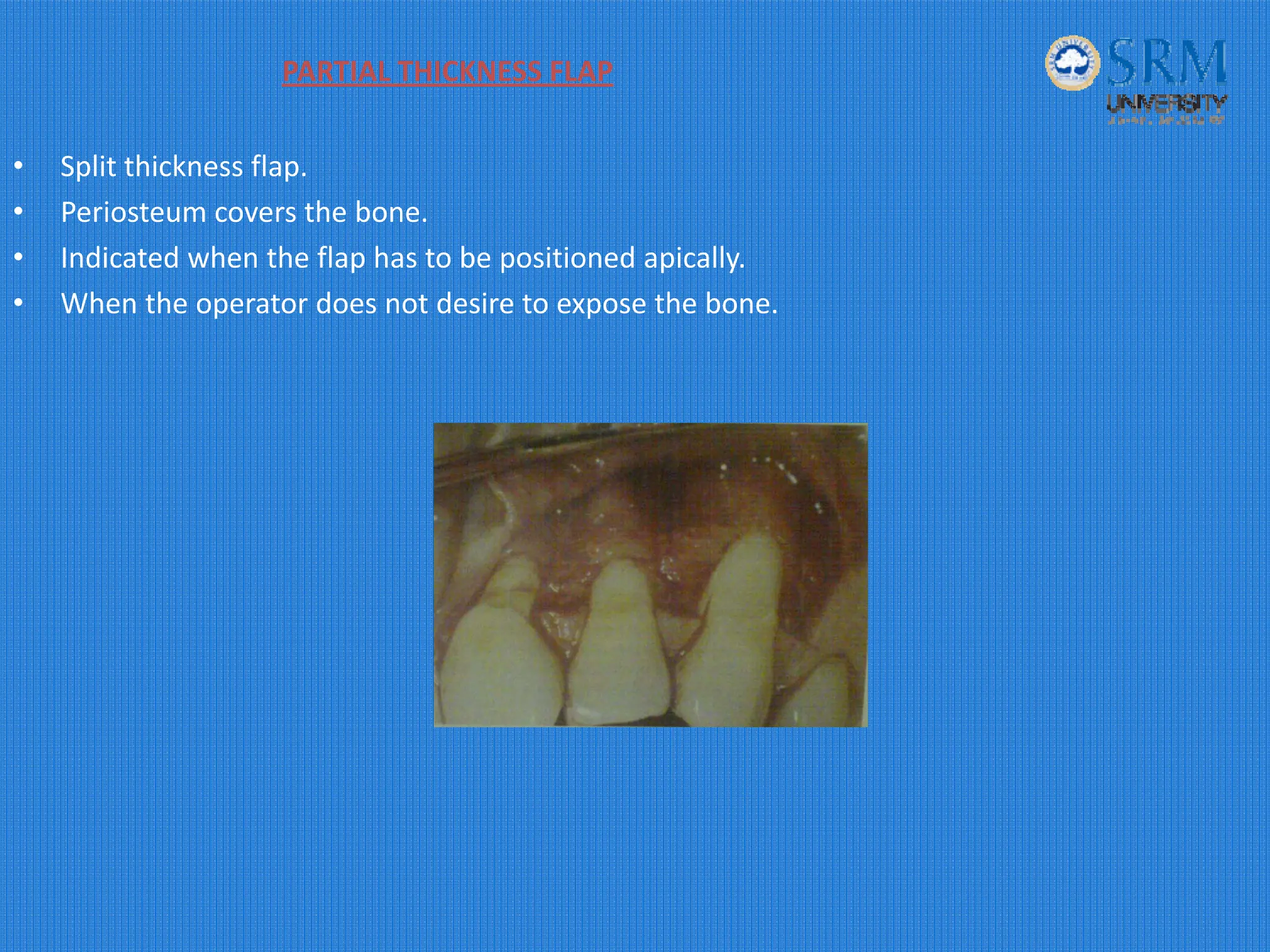 PERIODONTAL.pdf. Perio.flap.surgery.periodontics | PDF