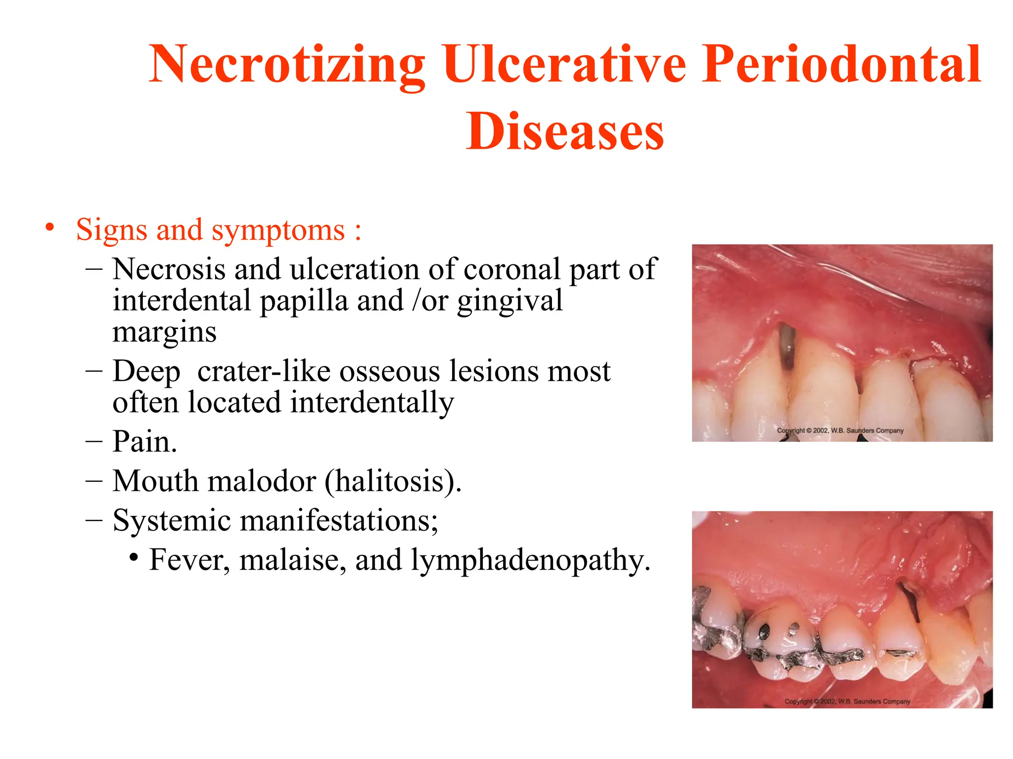 Periodontal-Diseases-III.ppt classification) | PPT
