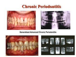 Periodontal-Diseases-III.ppt classification) | PPT