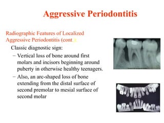 Periodontal-Diseases-III.ppt classification) | PPT