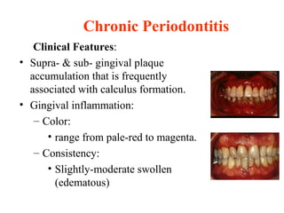 Periodontal-Diseases-III.ppt classification) | PPT
