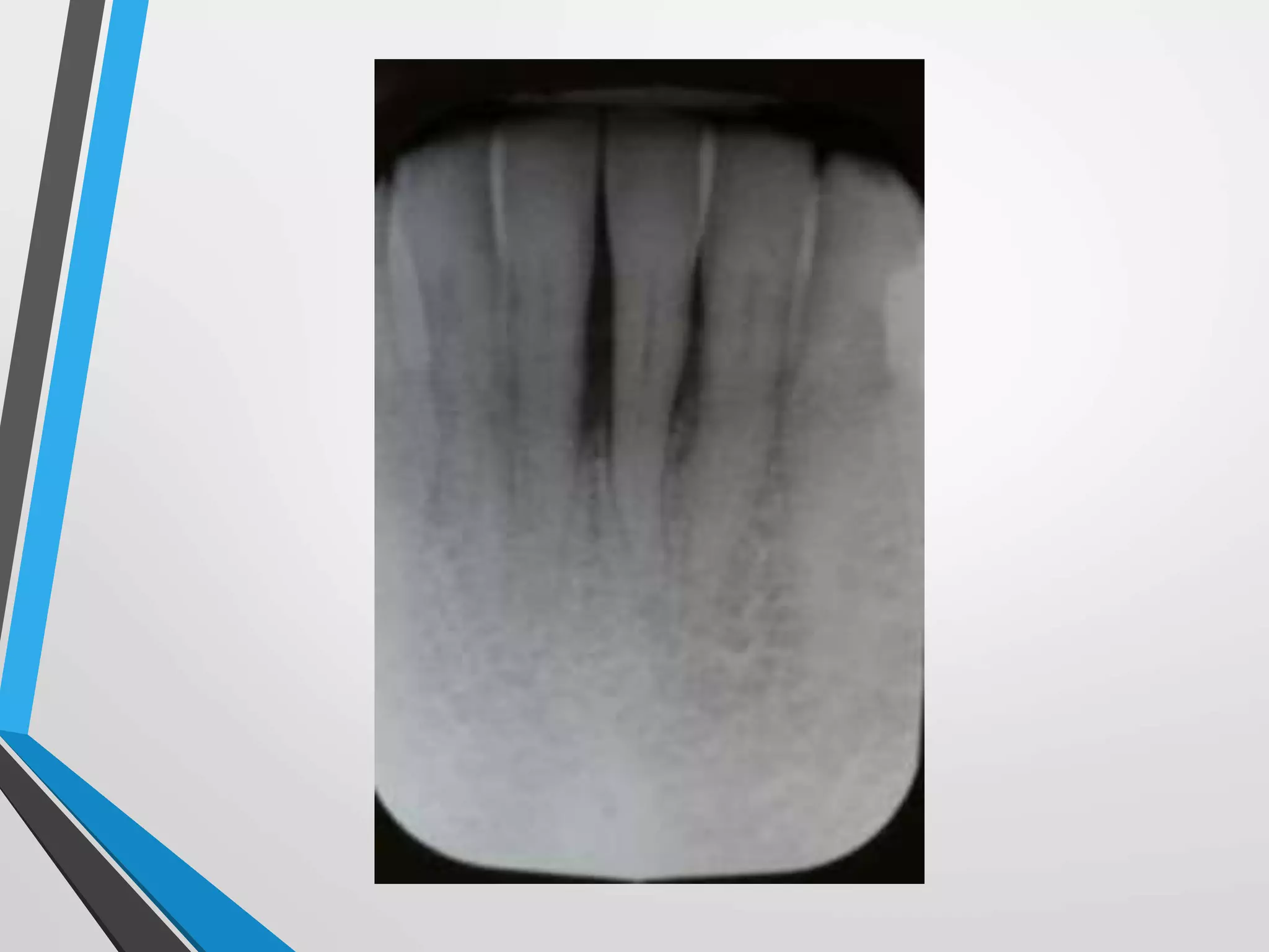 Periodontal pocket and CAL | PPTX