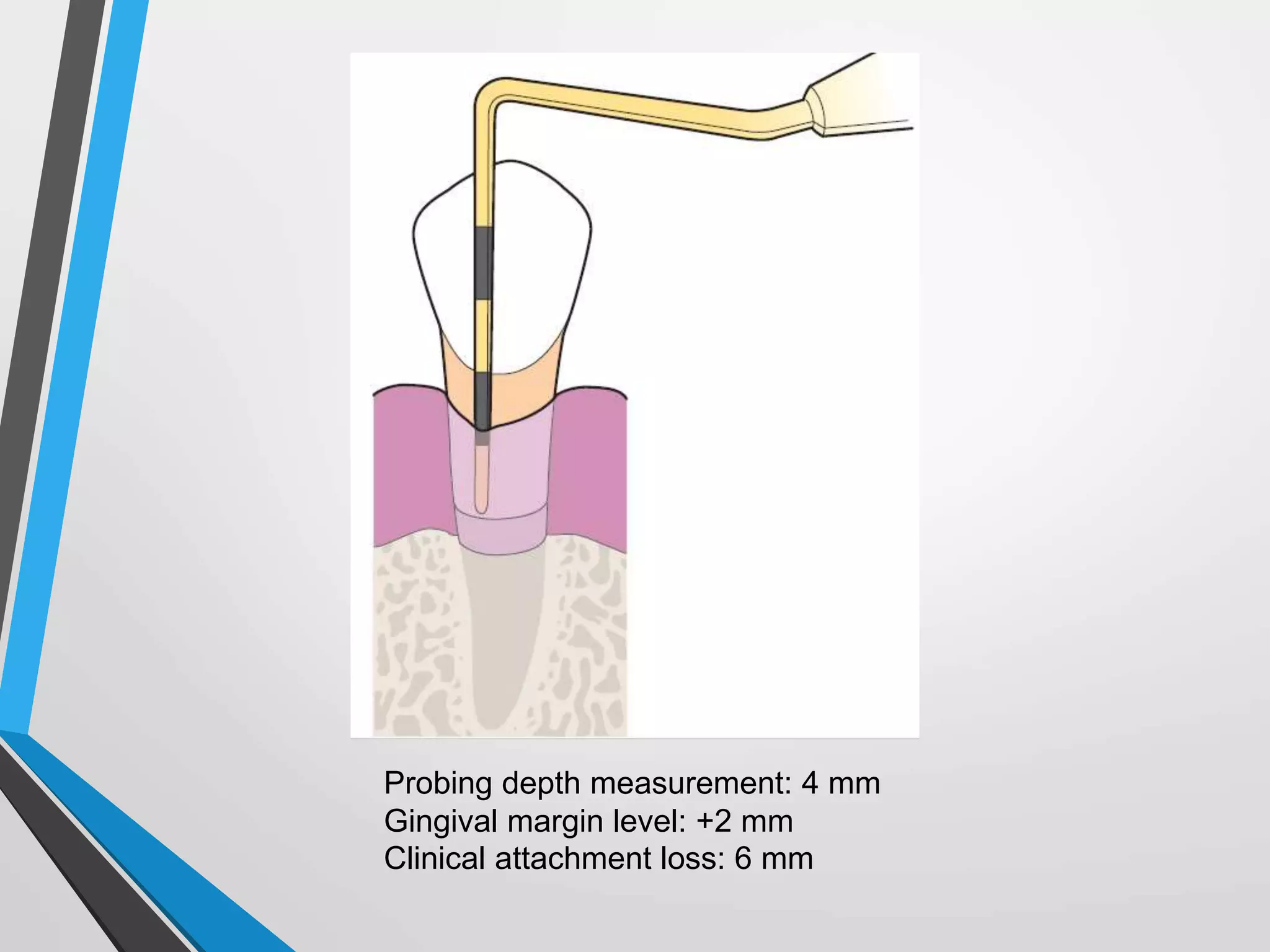 Periodontal pocket and CAL | PPTX