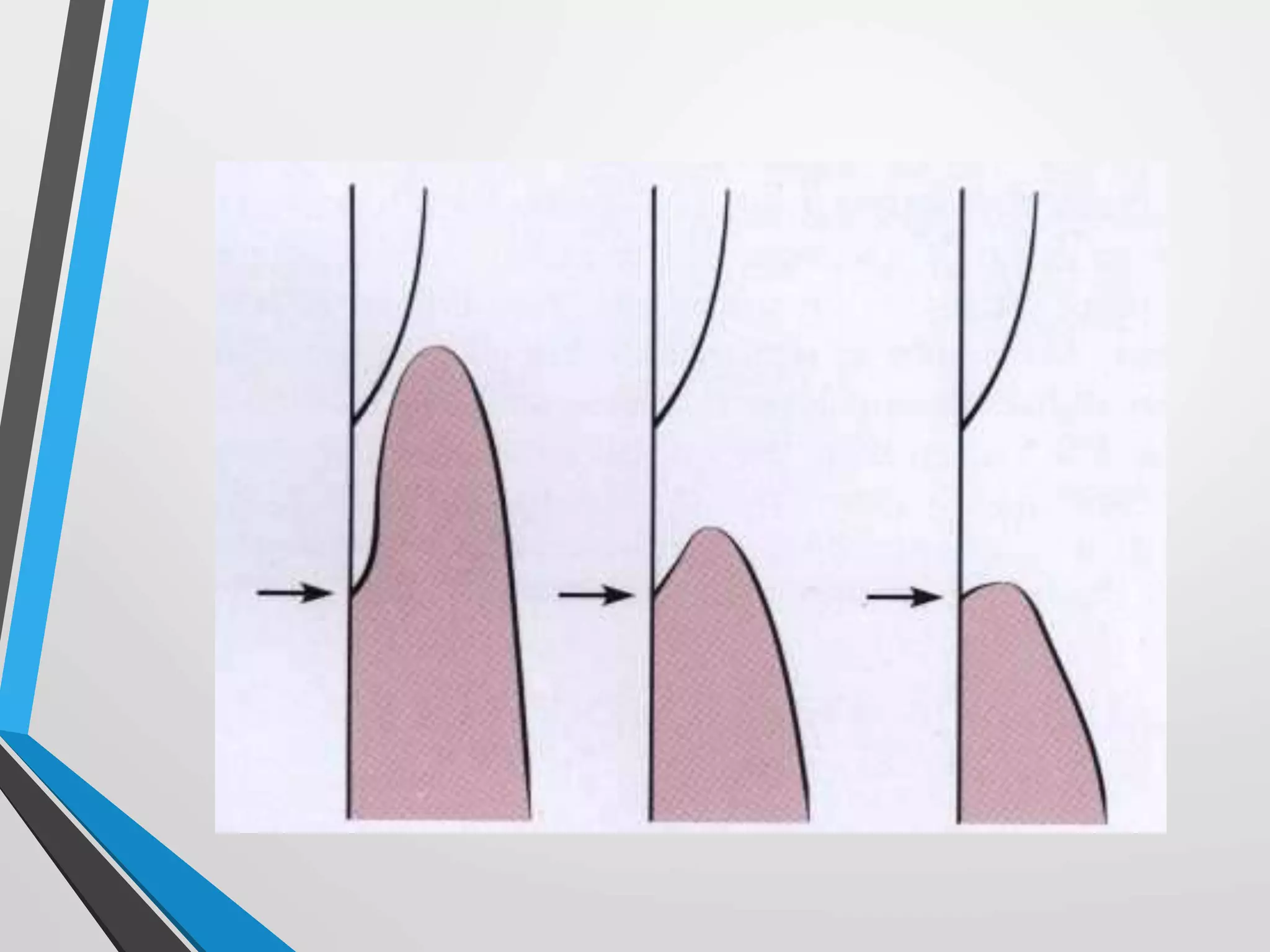 Periodontal pocket and CAL | PPTX