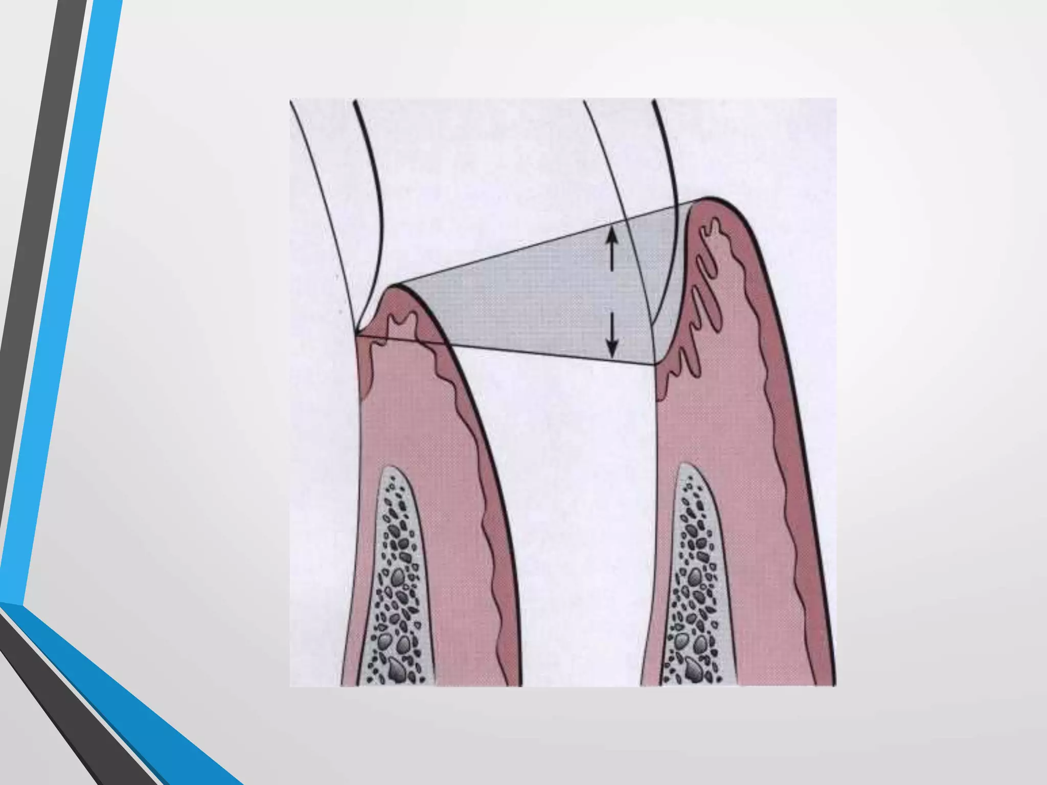 Periodontal pocket and CAL | PPTX