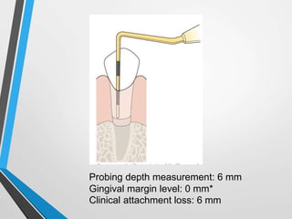 Periodontal pocket and CAL | PPTX