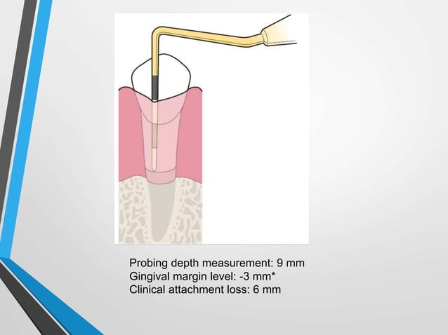 Periodontal pocket and CAL | PPTX