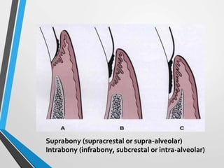 Periodontal pocket and CAL | PPTX
