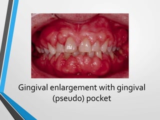 Periodontal pocket and CAL | PPTX