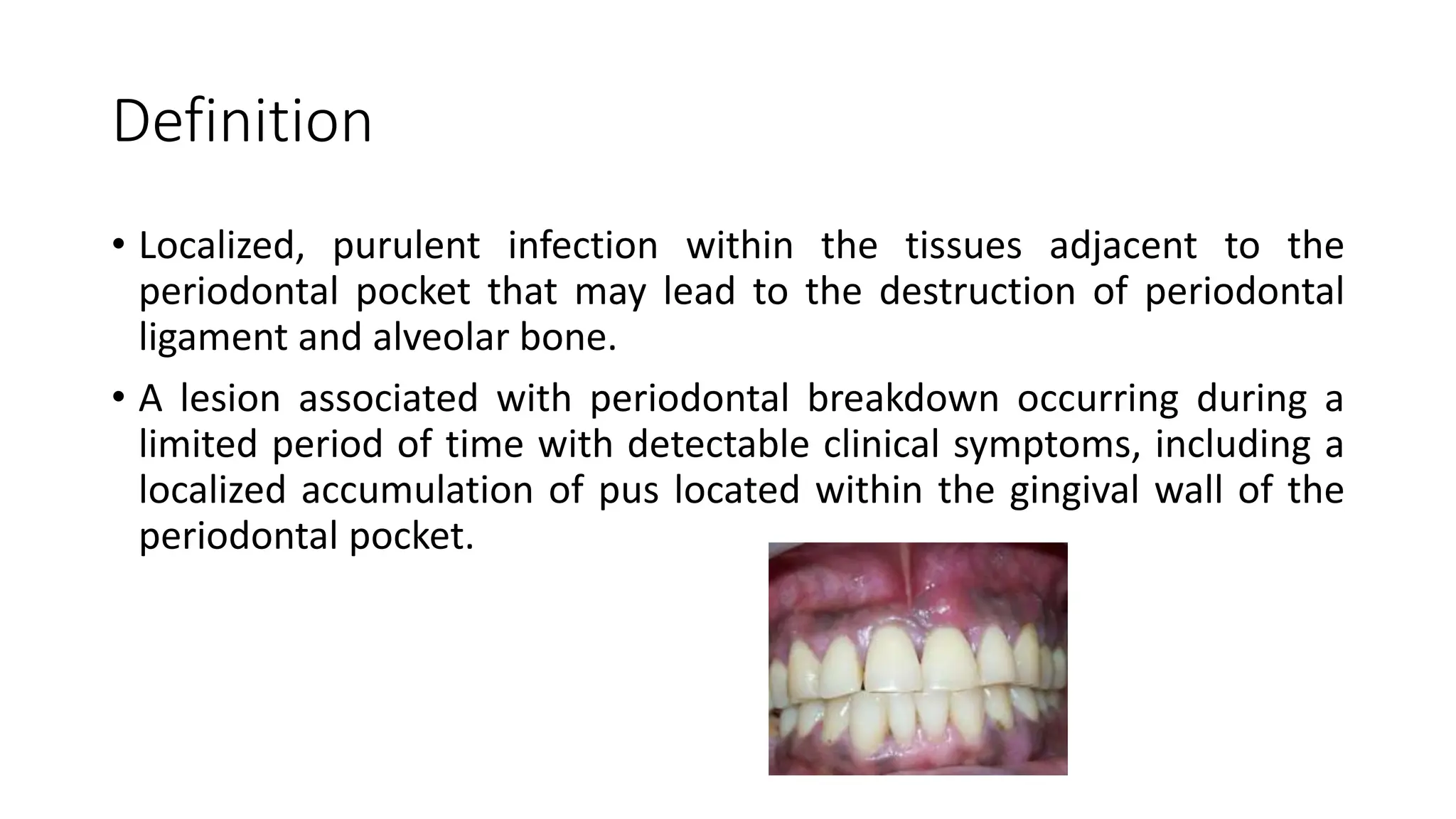 Periodontal abcess in dentistry concise view.pptx