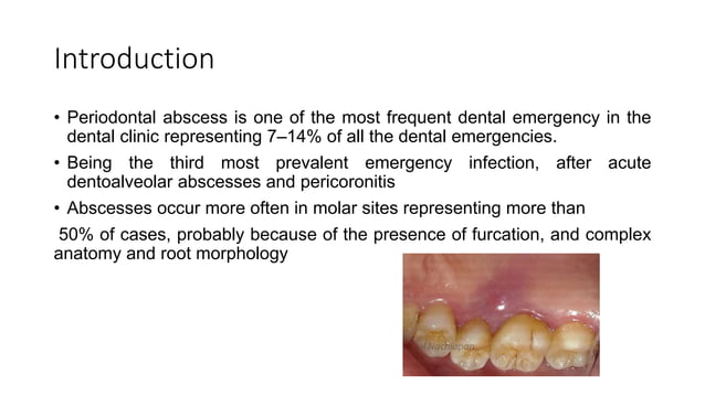 Periodontal abcess in dentistry concise view.pptx