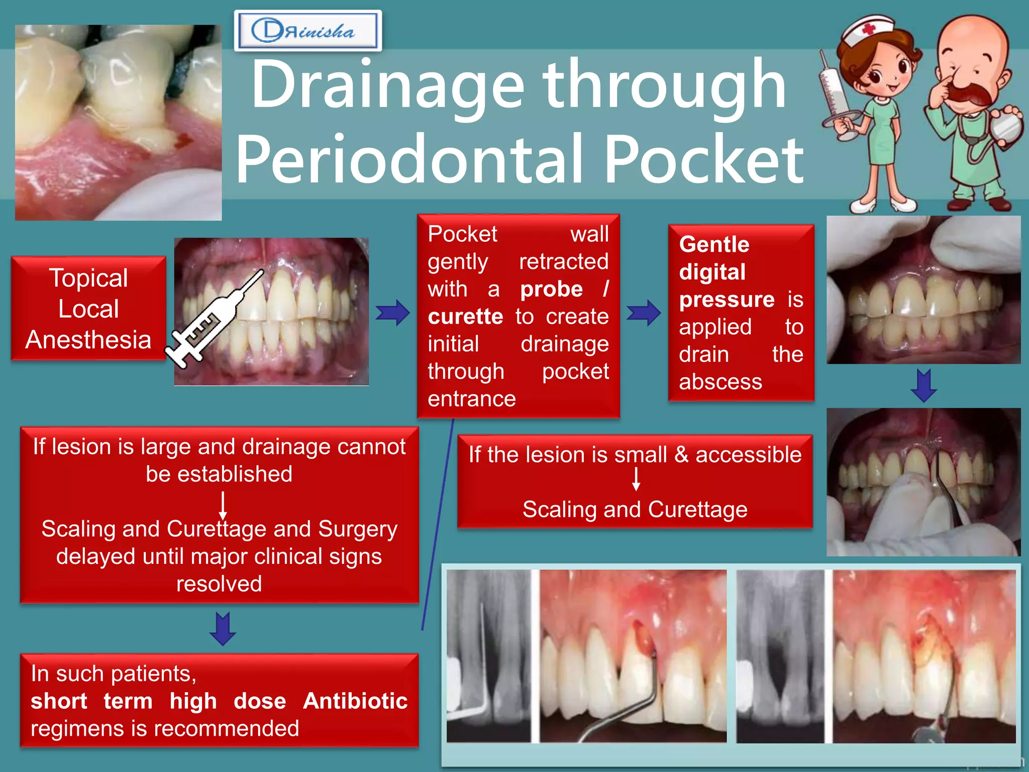 Periodontal Abscess | PPTX