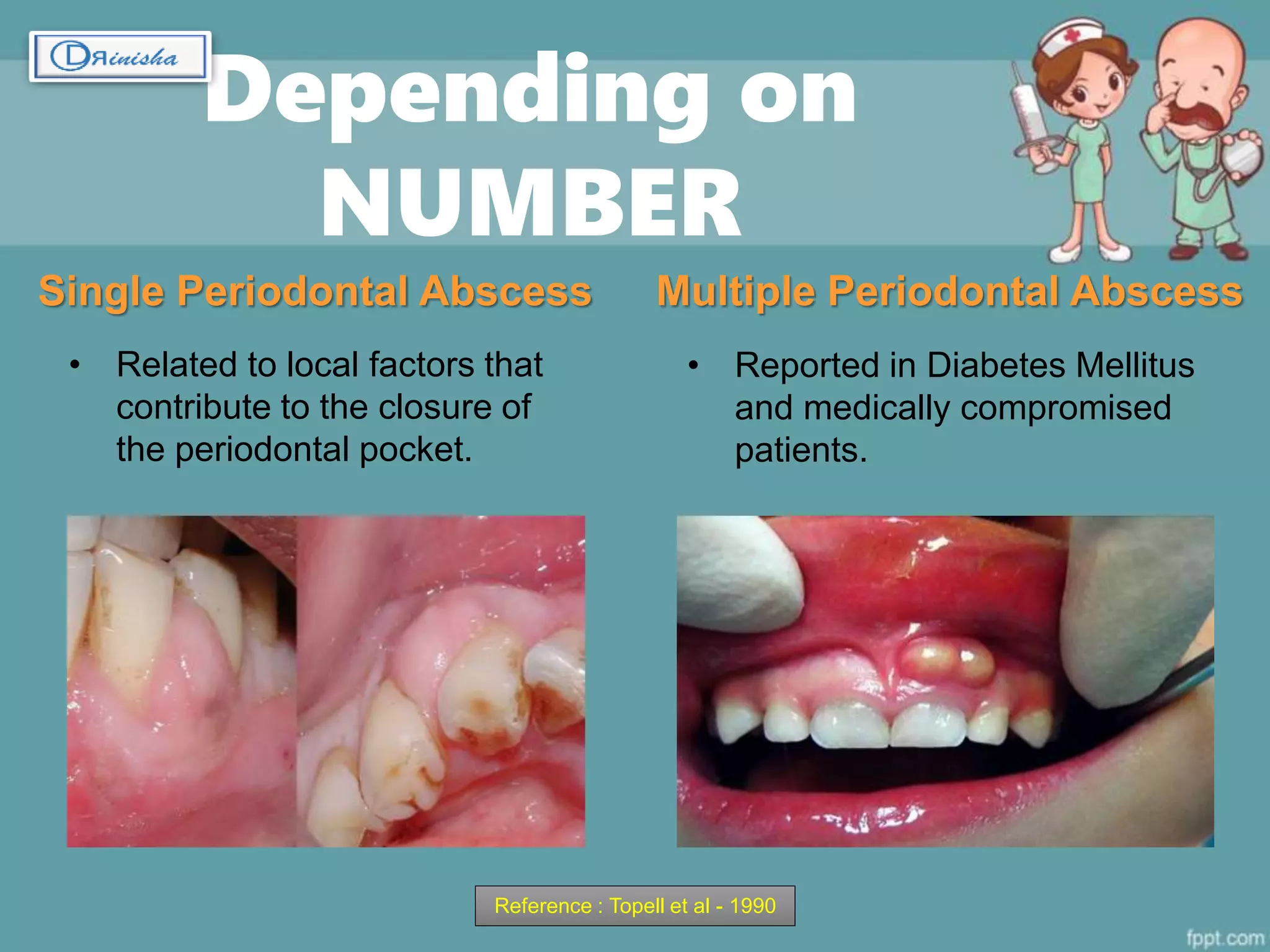 Periodontal Abscess | PPTX