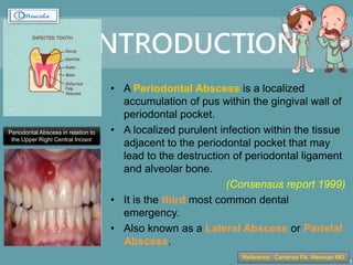 Periodontal Abscess | PPTX