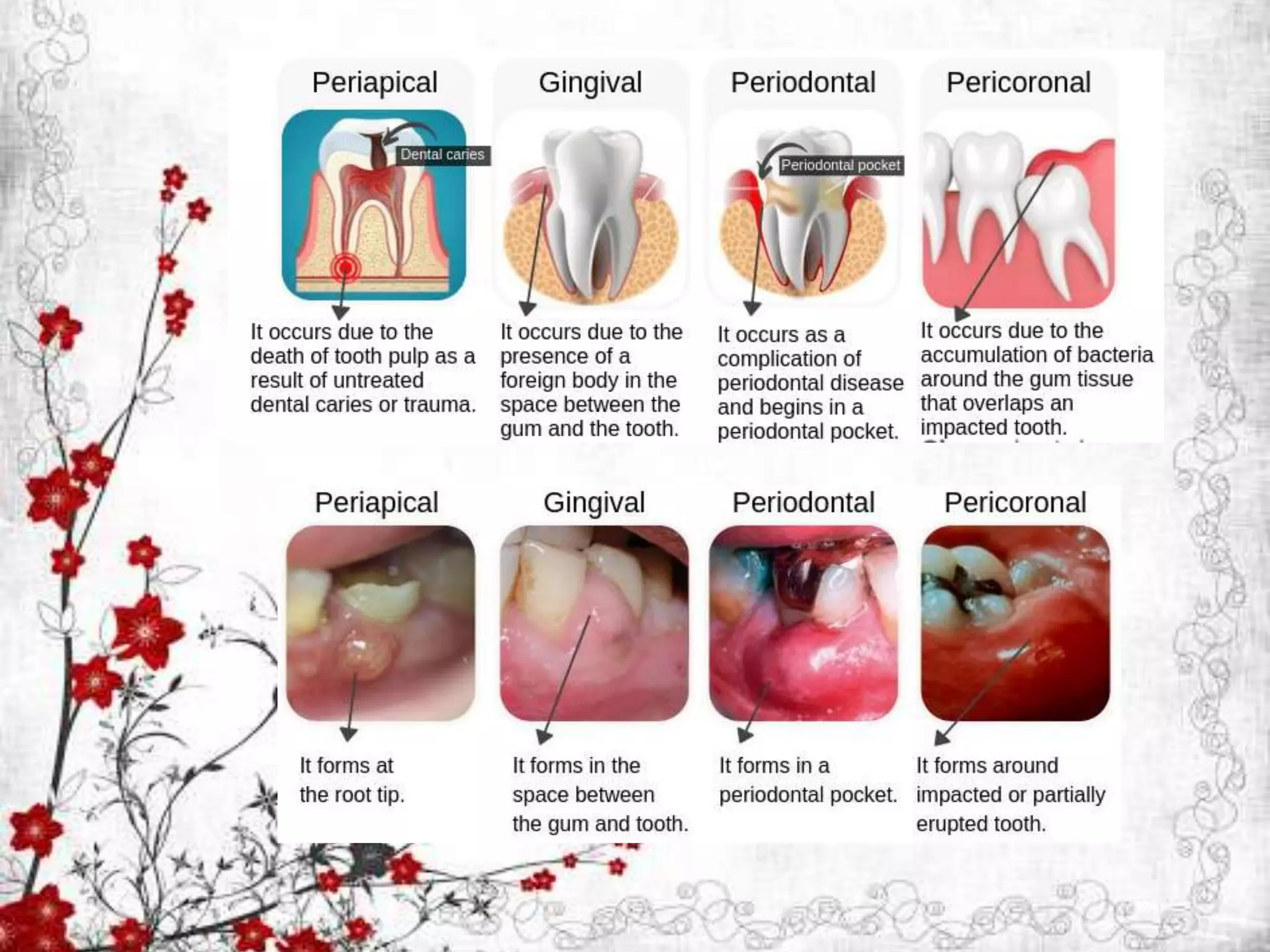 Periodontal abscess | PPTX