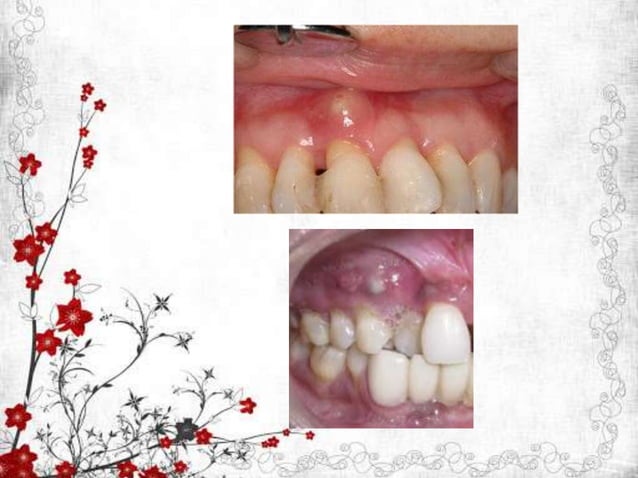 Periodontal abscess | PPTX