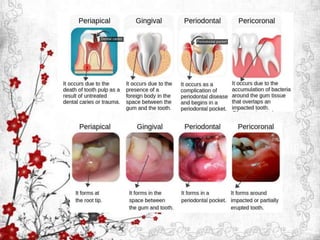Periodontal Abscess Vs Periapical Abscess