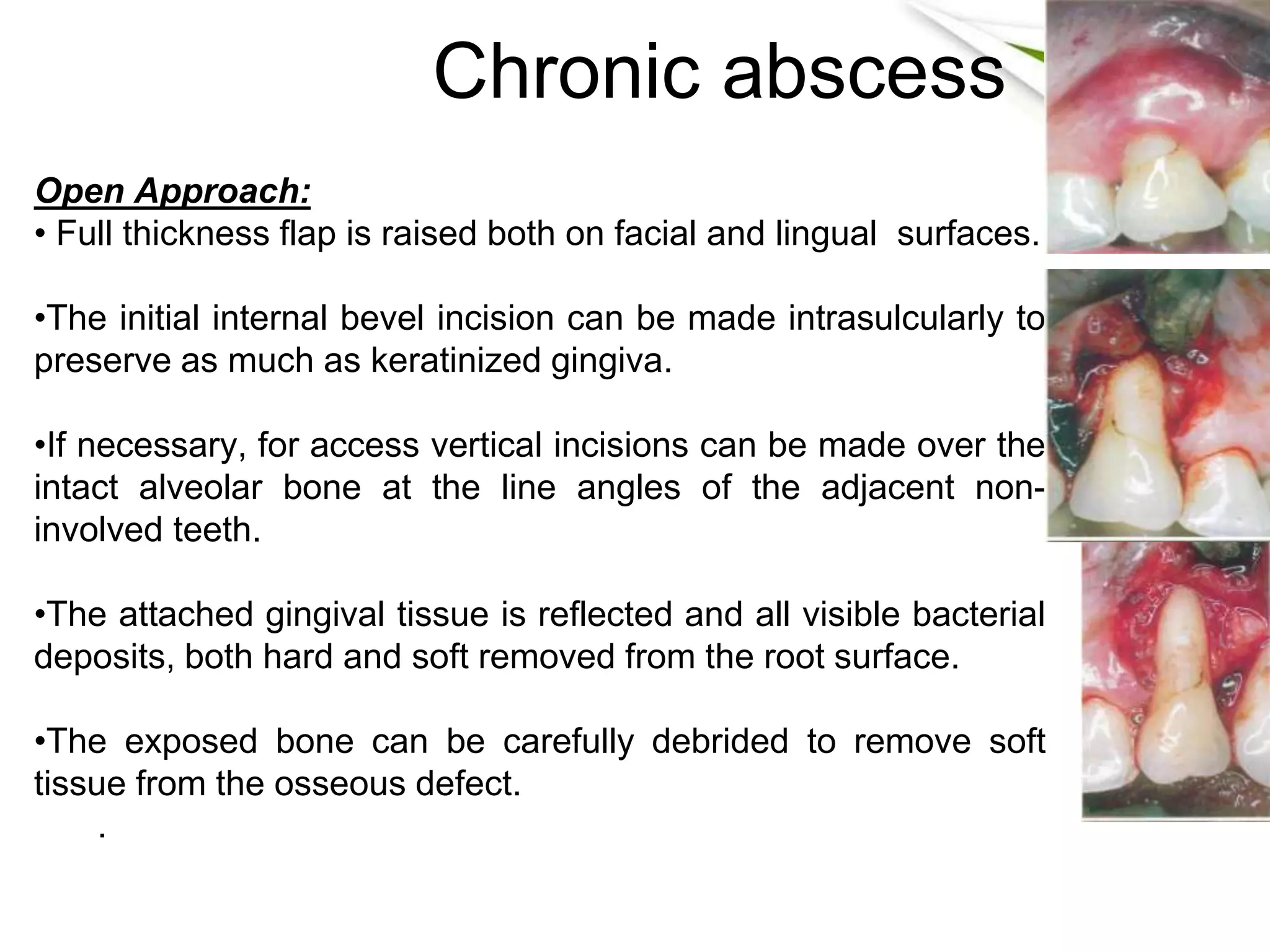 Periodontal abscess.pptx