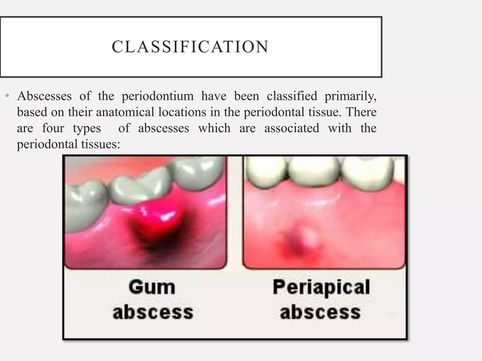 Periodontal abscess.pptx
