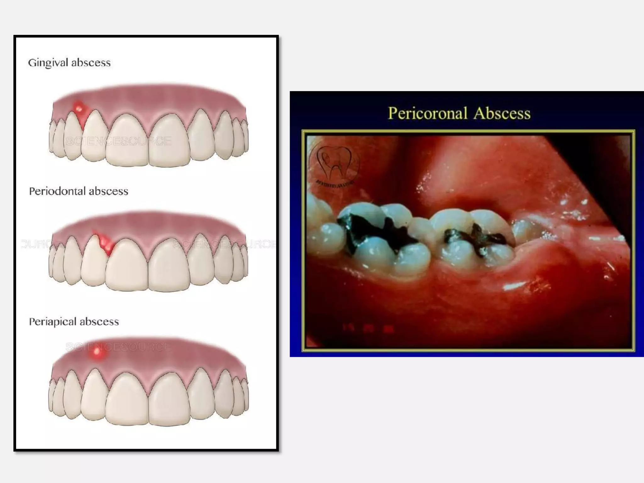 Periodontal abscess.pptx
