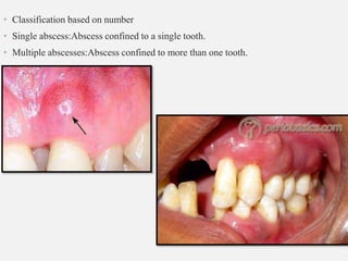 Periodontal abscess.pptx