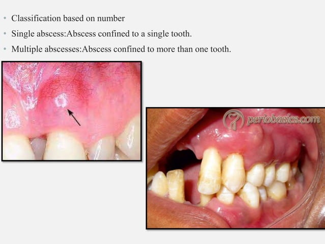 Periodontal abscess.pptx