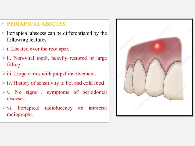 Periodontal abscess.pptx