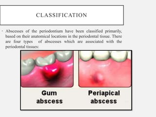 Periodontal abscess.pptx