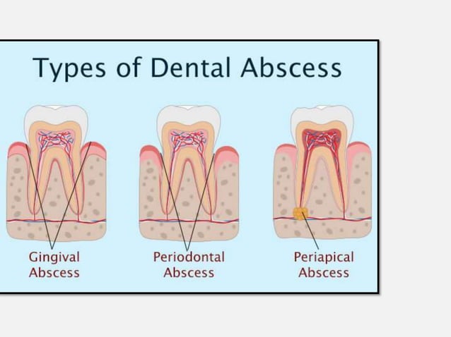 Periodontal abscess.pptx
