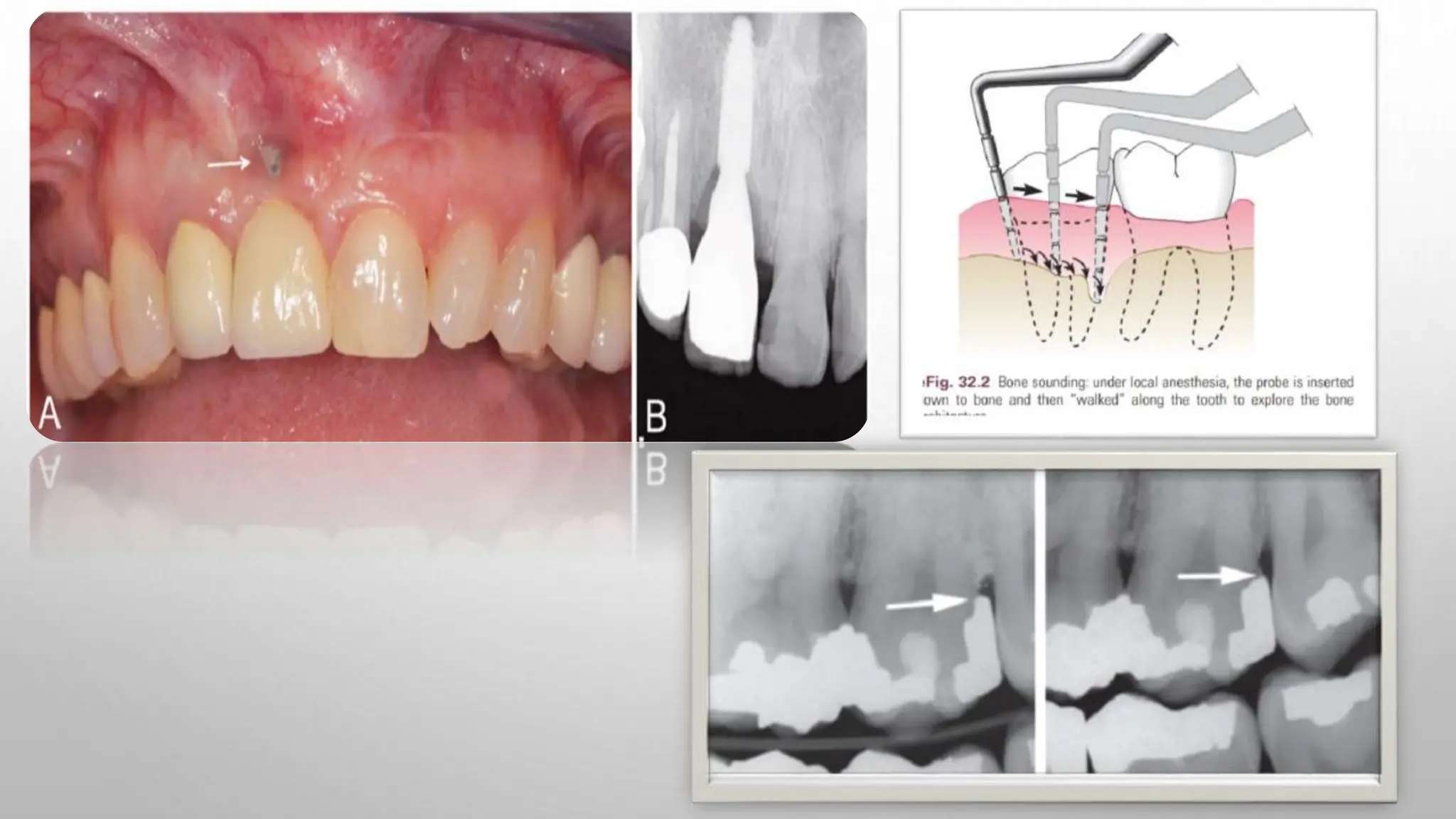 periodontal abscess.pptx