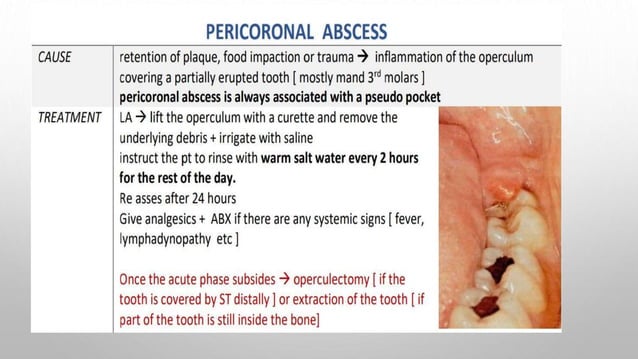 periodontal abscess.pptx