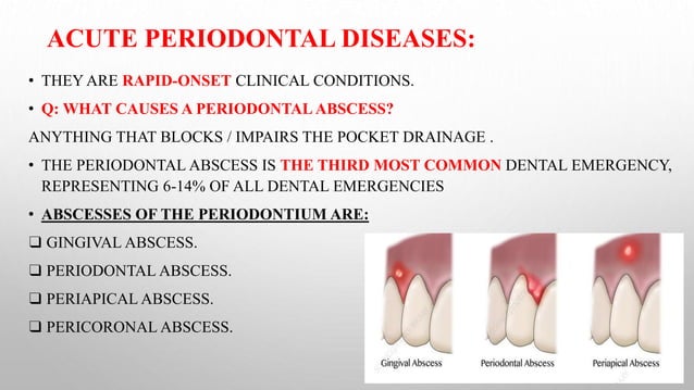 periodontal abscess.pptx