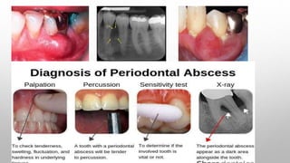 periodontal abscess.pptx