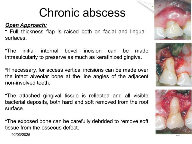 periodontal abscess etiology pathogenesis | PPT