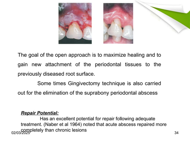 periodontal abscess etiology pathogenesis | PPT