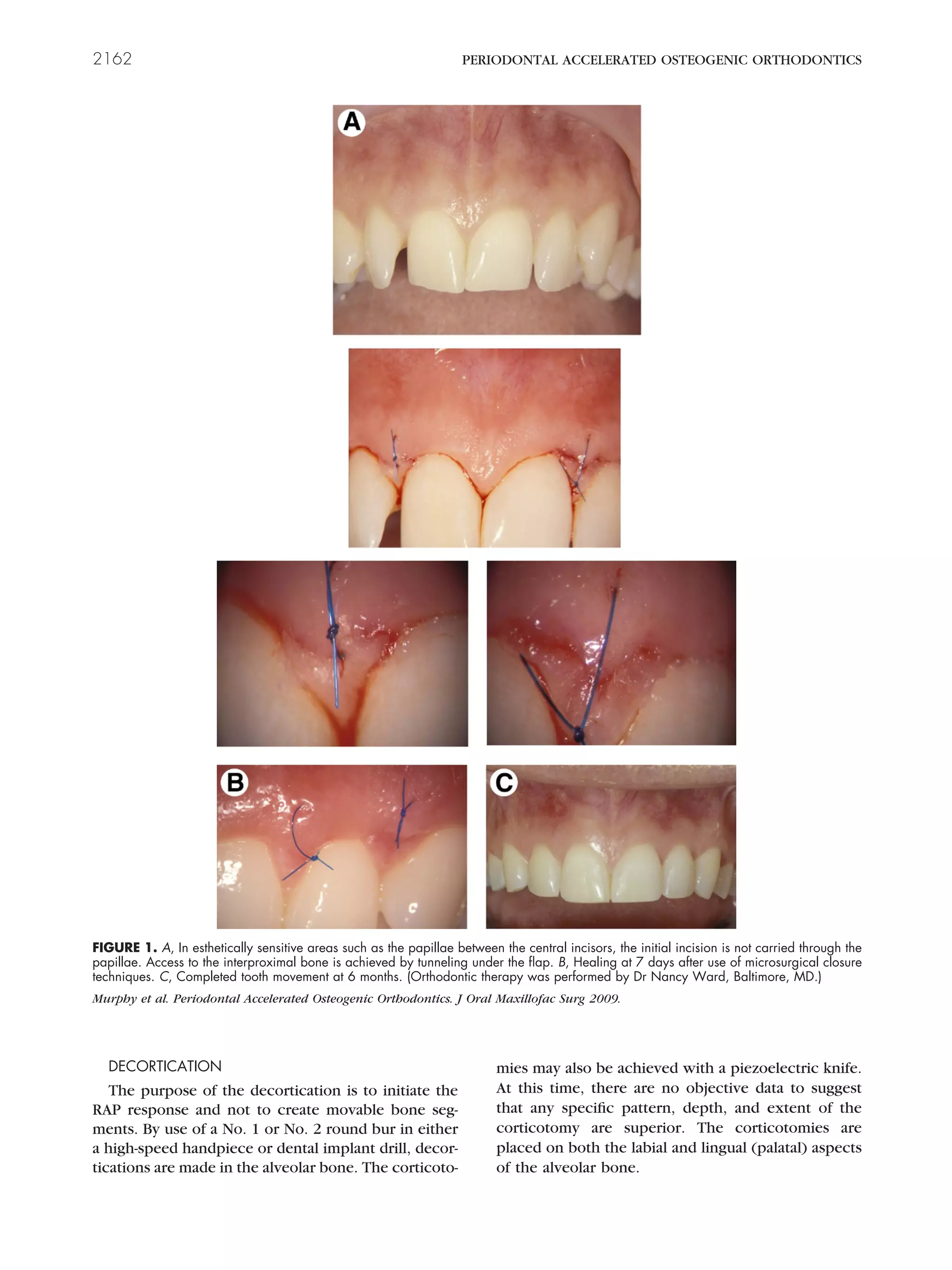 Periodontal Accelerated Osteogenic Orthodontics | PDF
