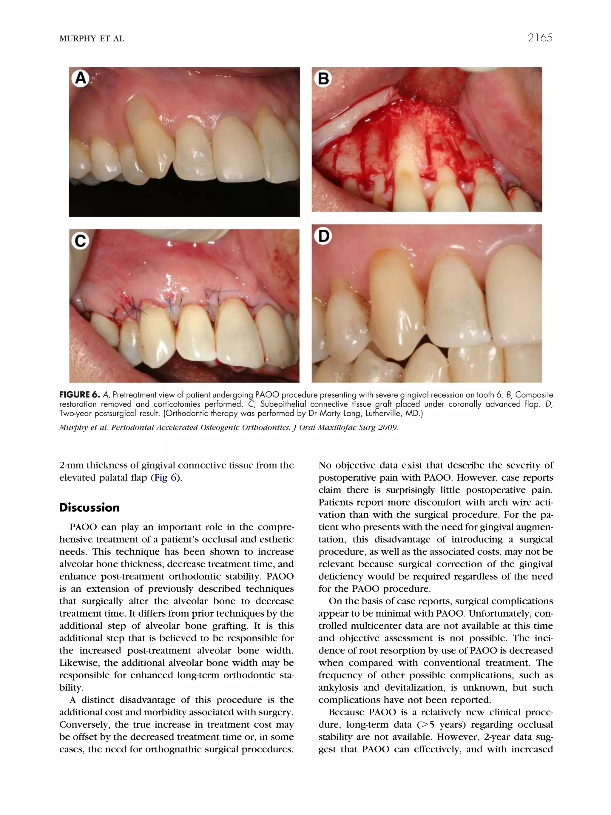 Periodontal Accelerated Osteogenic Orthodontics | PDF