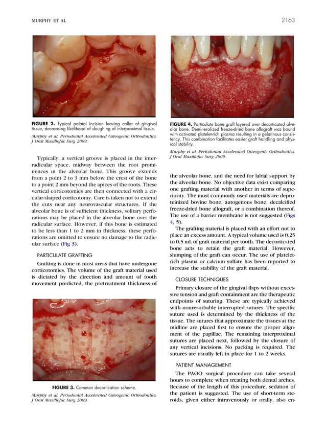 Periodontal Accelerated Osteogenic Orthodontics | PDF | Dental Health ...