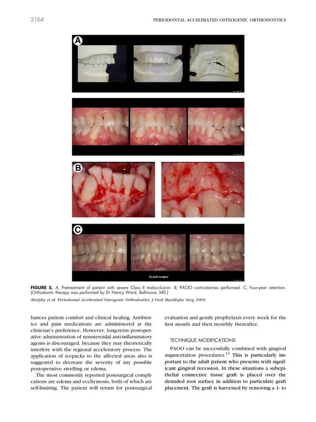 Periodontal Accelerated Osteogenic Orthodontics | PDF | Dental Health | Diseases and Conditions