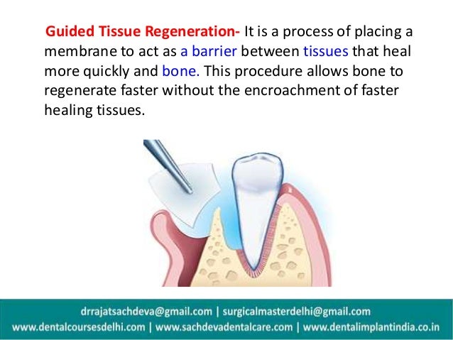 Periodontal Bone Regeneration , Regrowth Of Lost bone ,Osseous Regene…