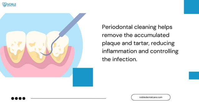 Periodontal Cleaning | PPTX