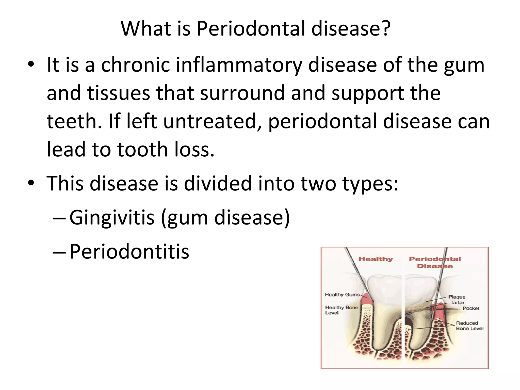 Periodontal disease | PPT