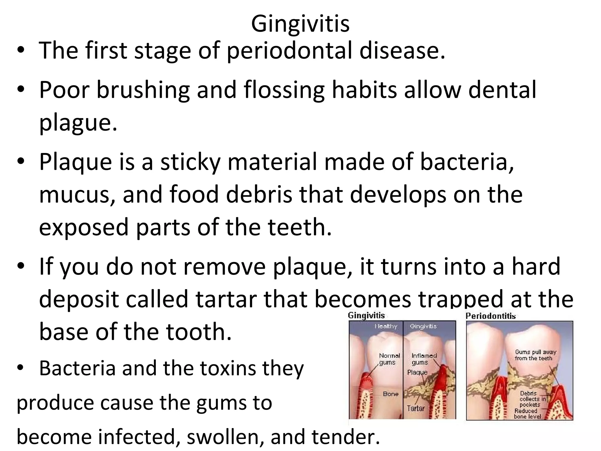 Periodontal disease | PPT