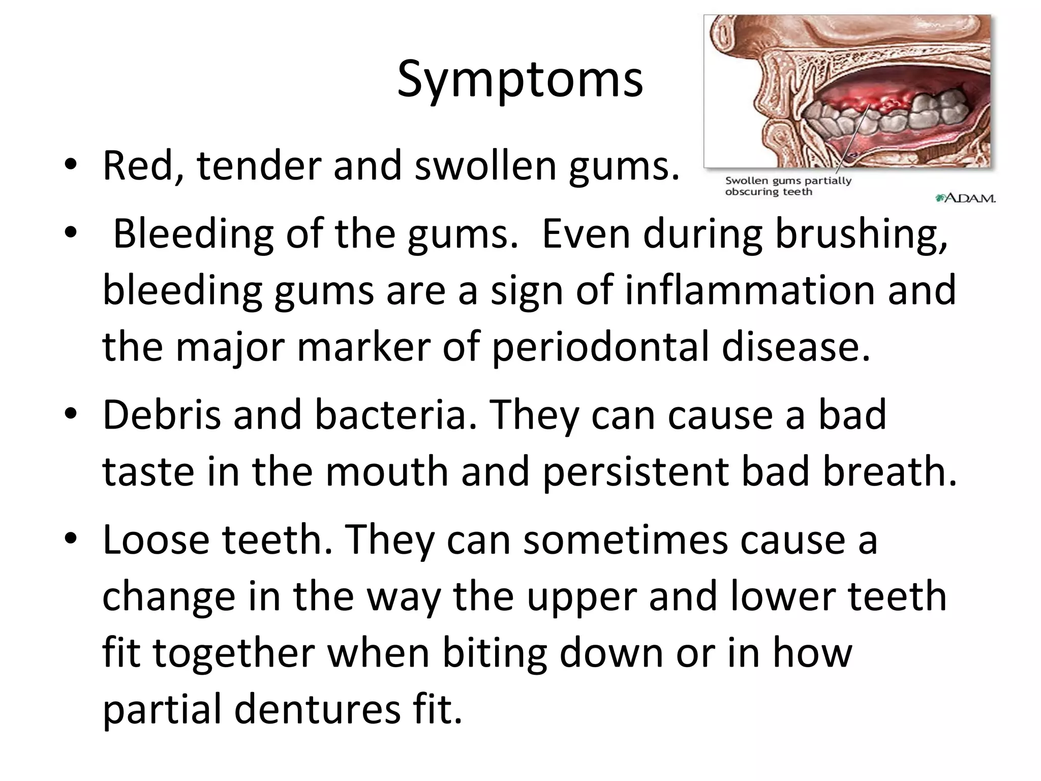 Periodontal disease | PPT