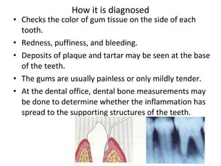 Periodontal disease | PPT | Oral care | Personal Care