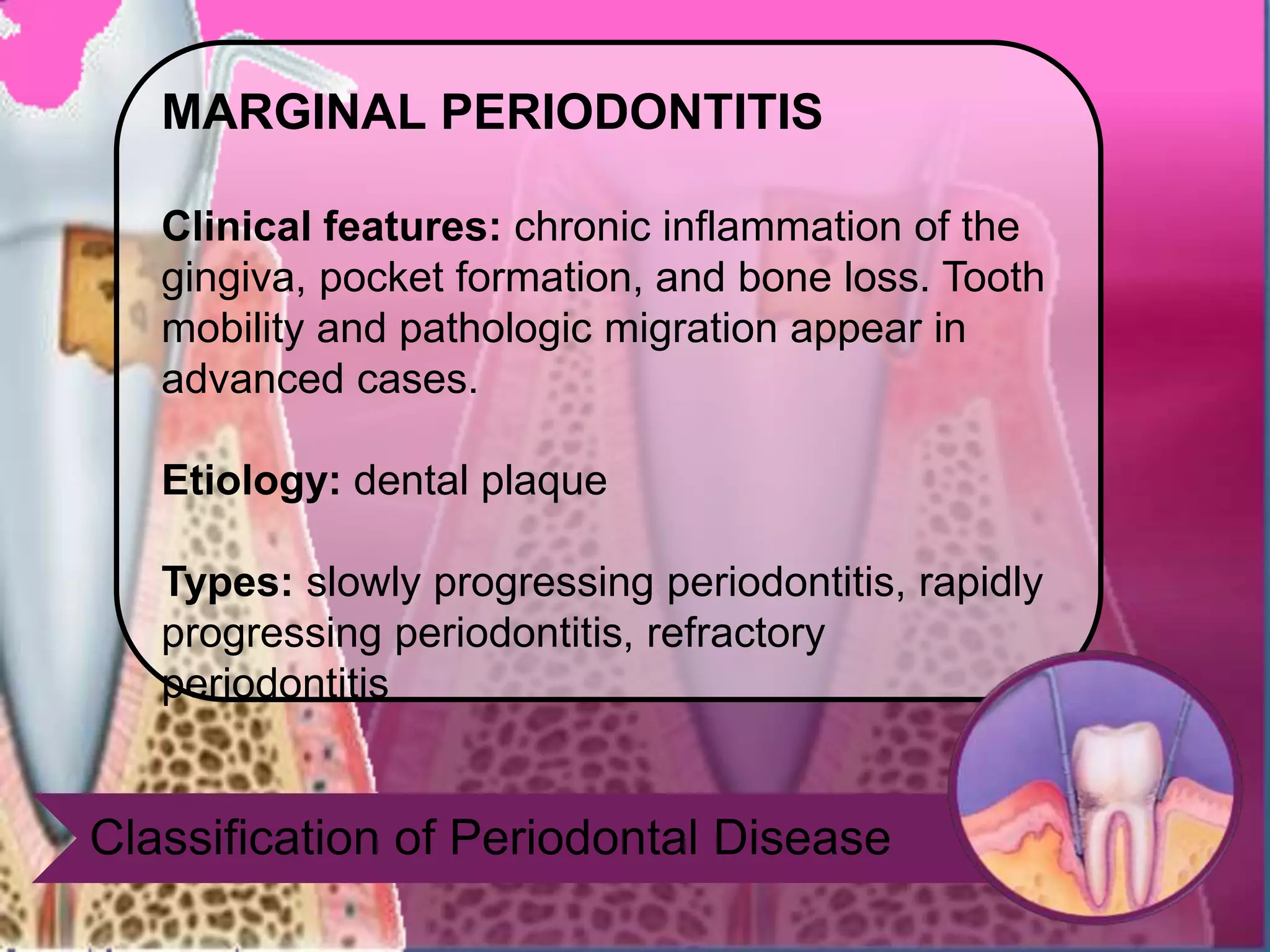 Periodontal disease | PPTX